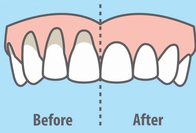 9 Easy Ways to Heal Receding Gums Naturally! - QueenMind
