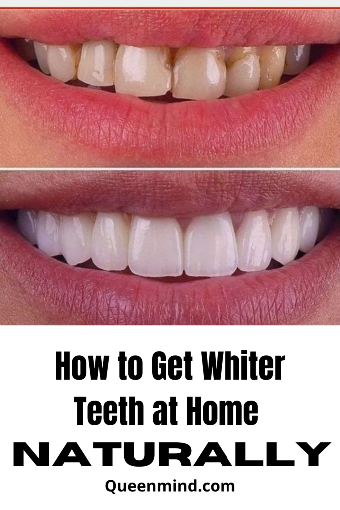 How to Get Whiter Teeth at Home Naturally - QueenMind