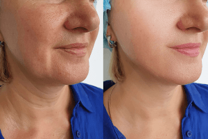 How to Get Rid of Turkey Neck: 10 Proven Ways to Tighten and Tone Your ...